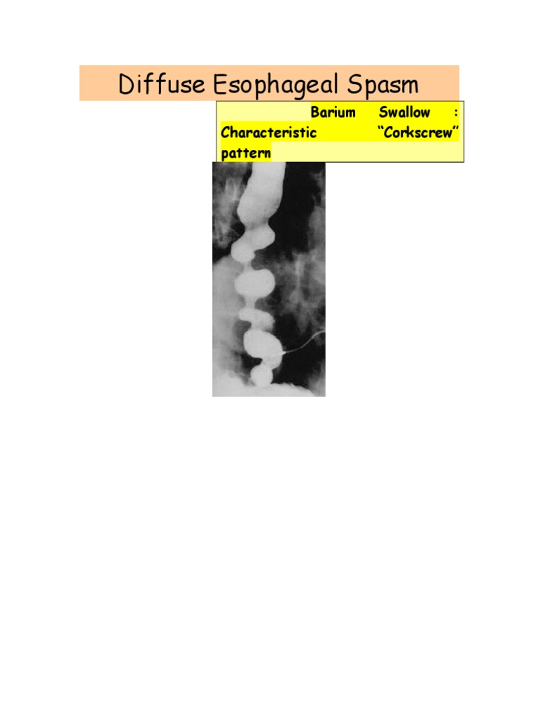 Diffuse Esophageal Spasm: Barium Swallow: Characteristic "Corkscrew ...