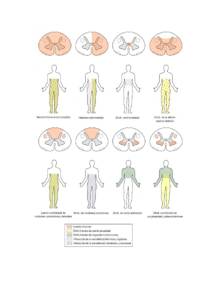 Lesión Medular: Shock y Síndromes | PDF | Anatomía | Medicina CLINICA