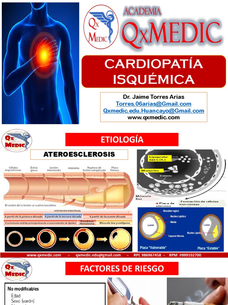 Cardiopatía Isquémica | Infarto de miocardio | Electrocardiografia
