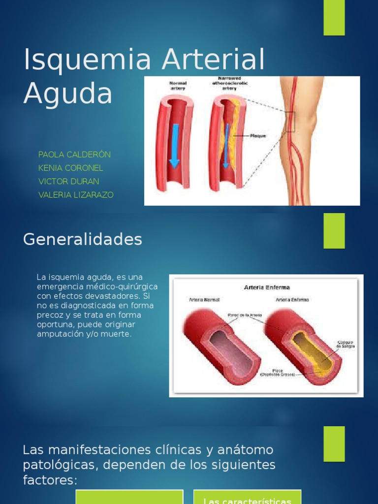 Isquemia Arterial Aguda | PDF | Isquemia | Trombo