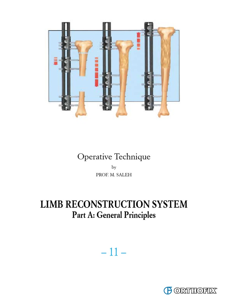 Limb Reconstruction System | PDF | Screw | Hip