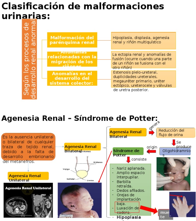 Agenesia Renal - Sindrome de Potter | PDF