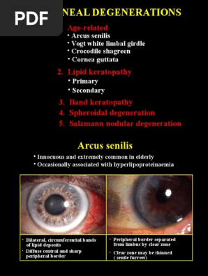 Limbus Sign And Arcus Senilis
