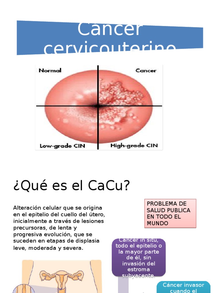 Clasificación y Estadificación del CaCu | PDF | Cáncer | Neoplasias