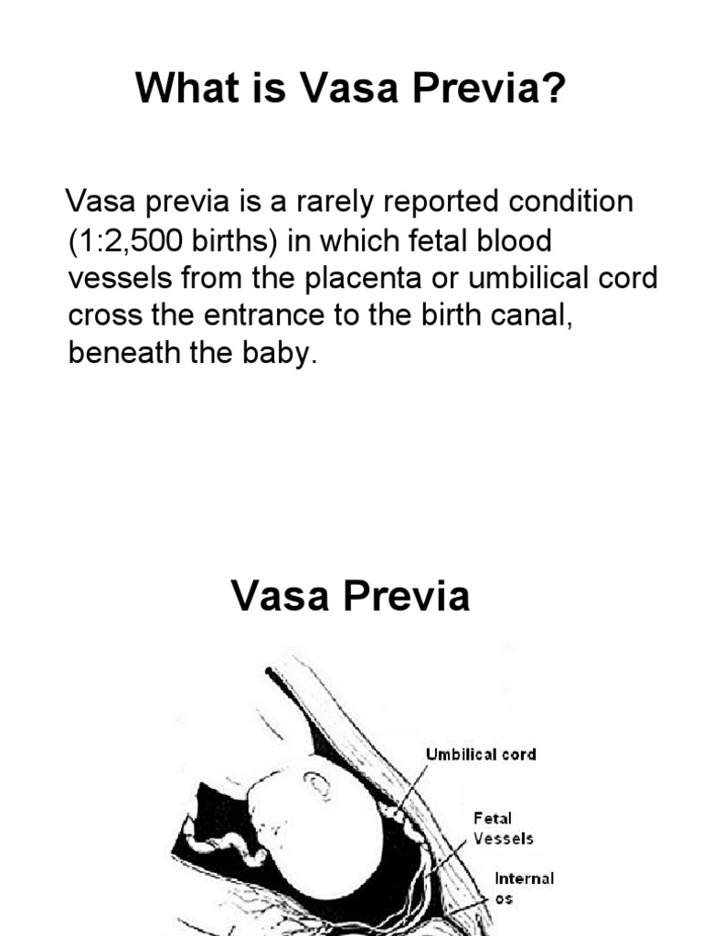 Vasa Previa - Antenatal Hemorrhage, Pregnancy | PDF