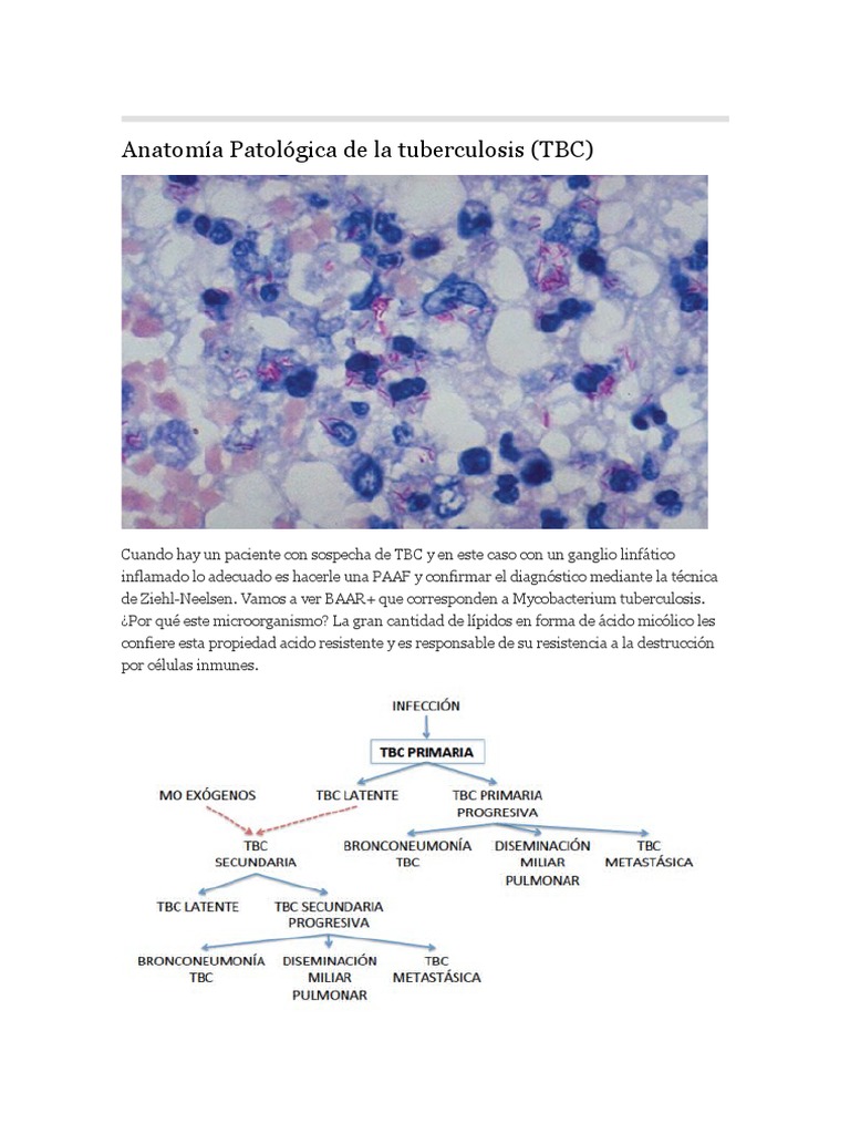 Anatomía Patológica de La Tuberculosis | Tuberculosis | Inflamación