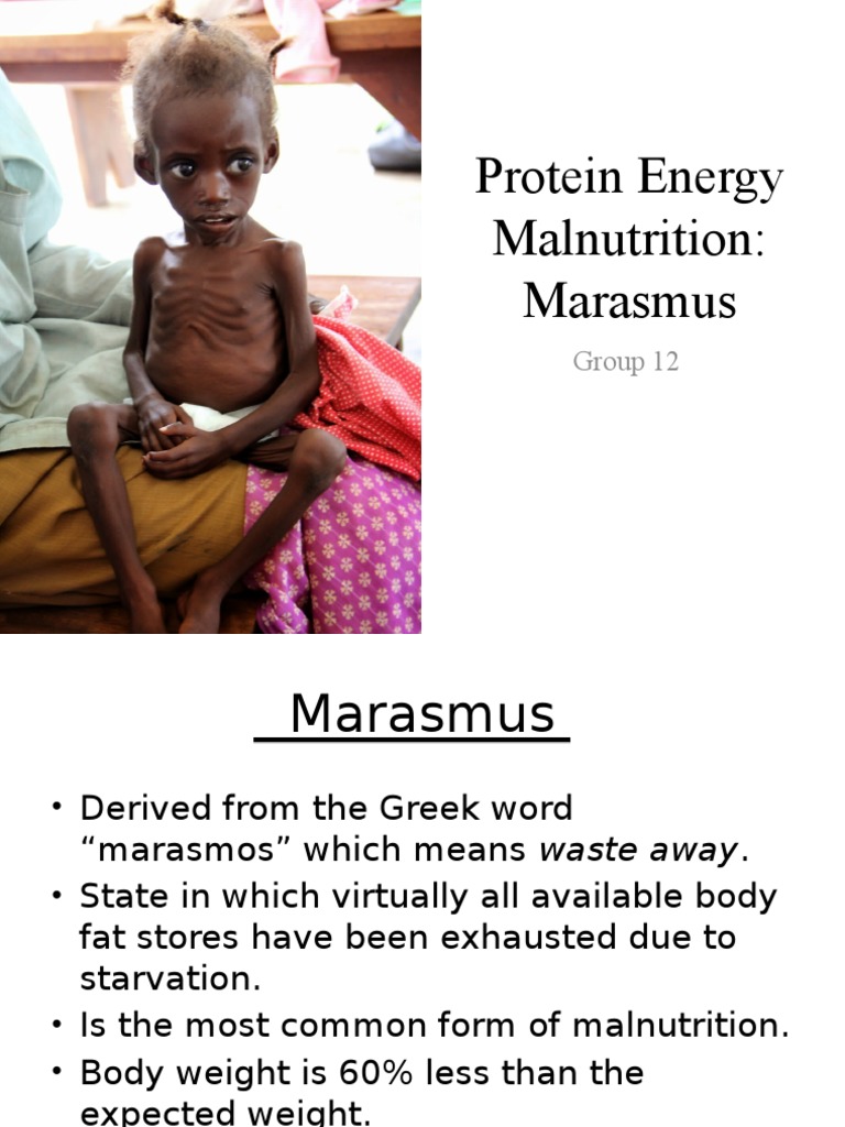 Clinical Marasmus | PDF | Malnutrition | Cortisol