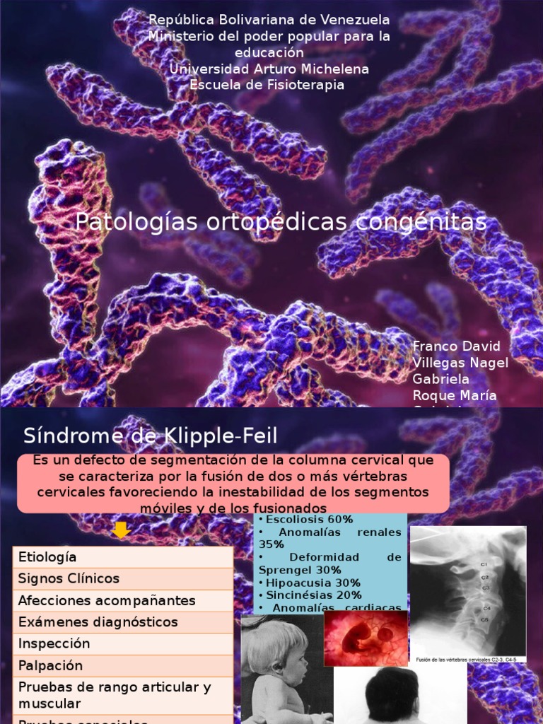 Disostosis Cleidocraneal | Escoliosis | Medicina CLINICA