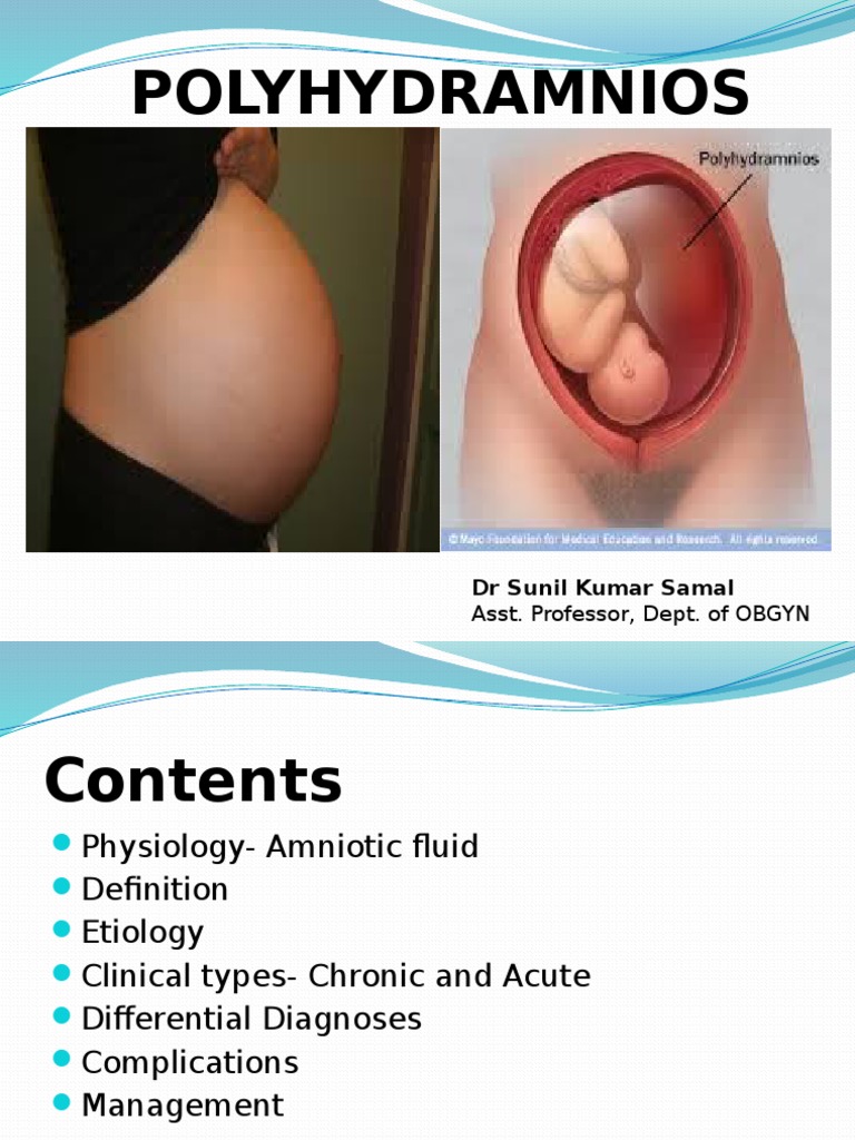 Polyhydramnios 160223064156 | PDF