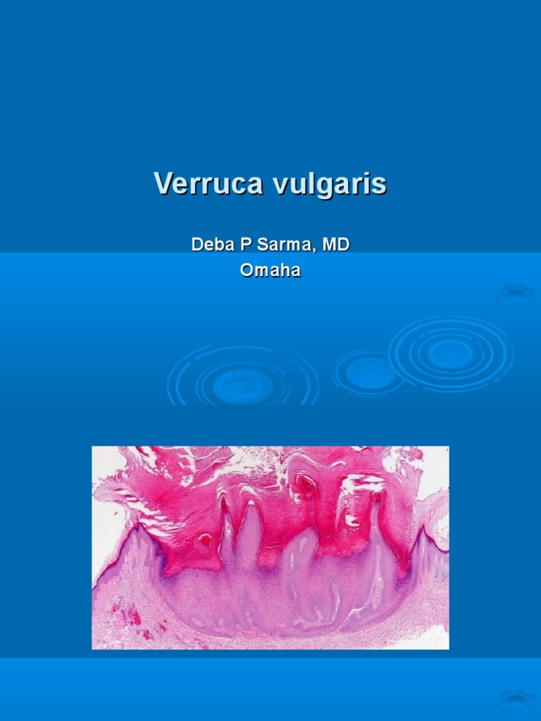 Verruca Vulgaris. | PDF | Home & Garden