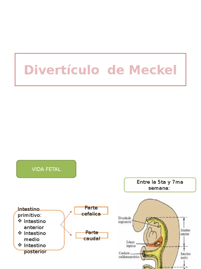 Divertículo de Meckel y conducto onfalomesentérico | PDF ...