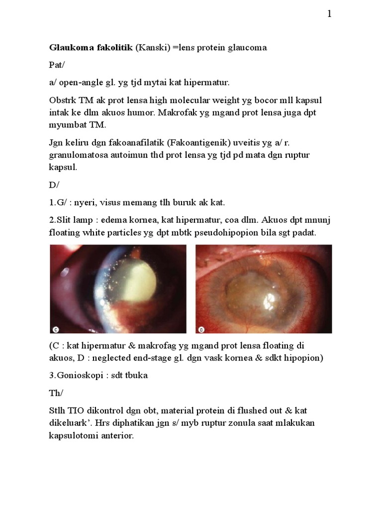 Glaukoma Fakolitik Kanski | PDF | Wellness