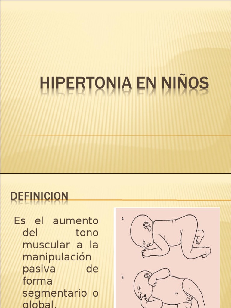 Hipertonia en Niños | PDF