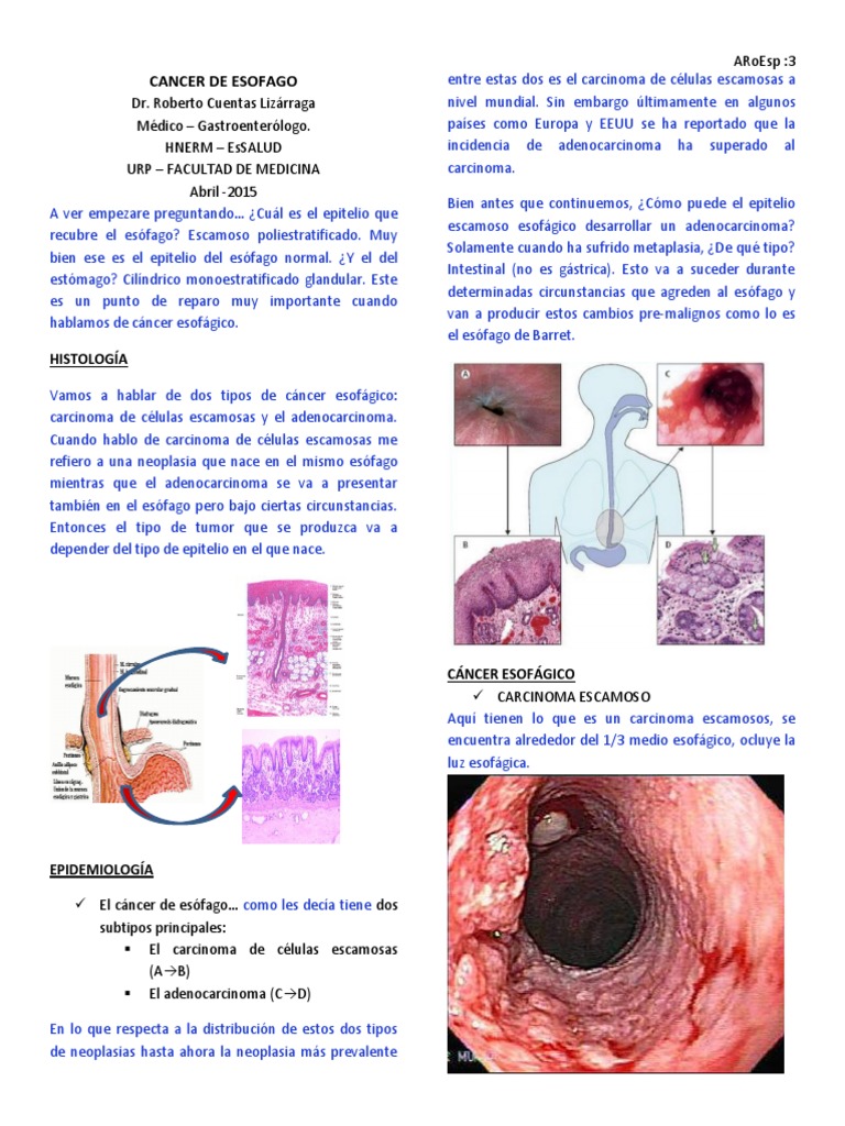 Cancer de Esofago | PDF | Cáncer de esófago | La enfermedad por reflujo ...