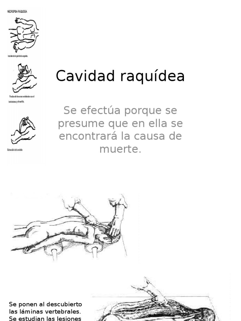 Autopsia. Cavidad Raquídea | PDF