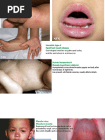 Koplik Spots: Key Measles Indicator | PDF | Measles | Infection