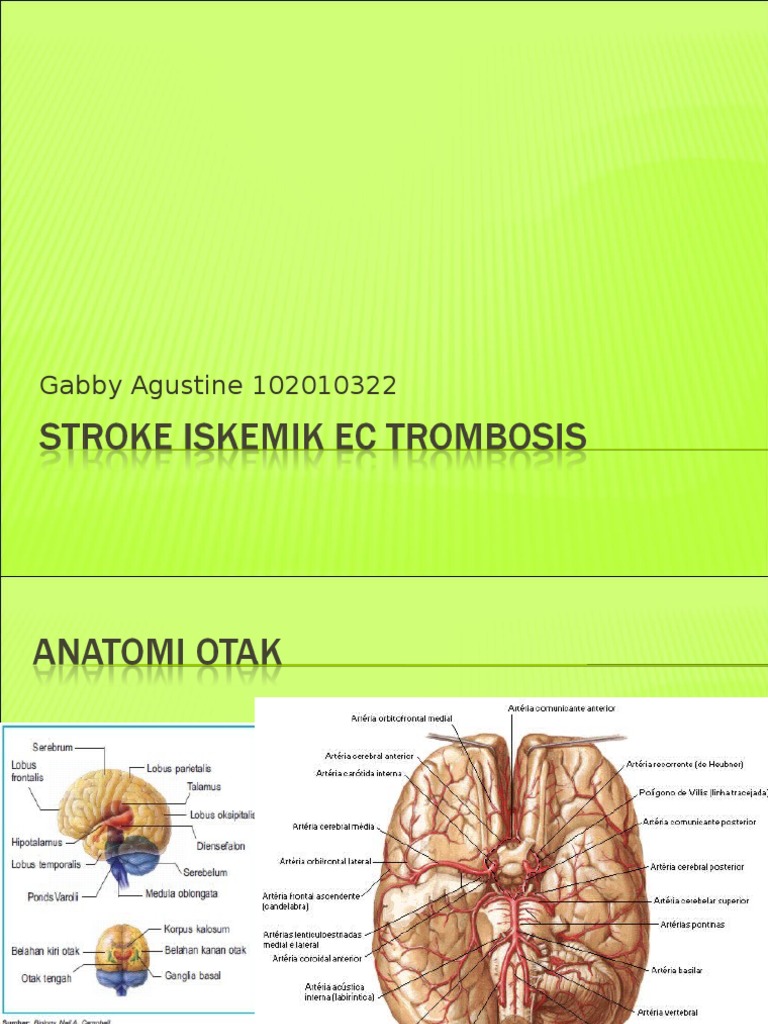 Stroke Iskemik Ec Trombosis | PDF