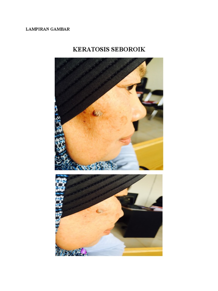 Keratosis Seboroik | PDF