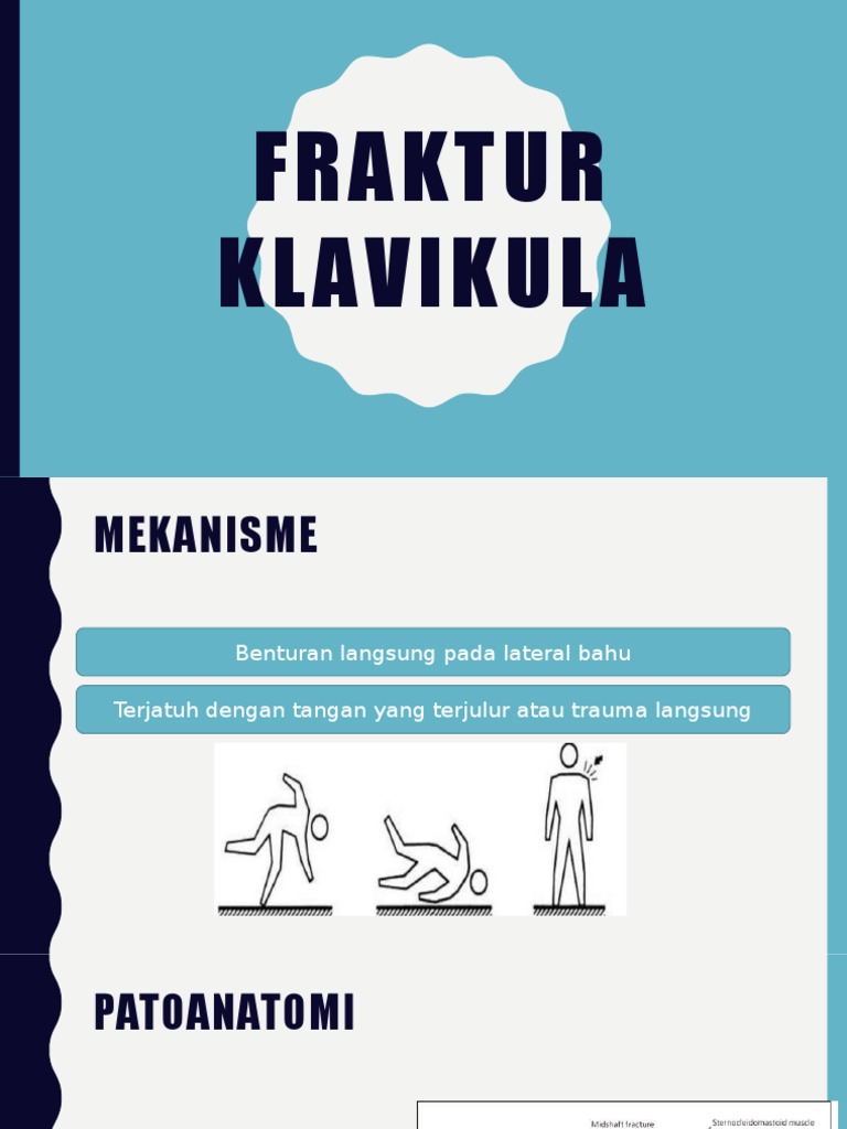 KLAVIKULA FRACTURE CLASSIFICATION AND MANAGEMENT | PDF