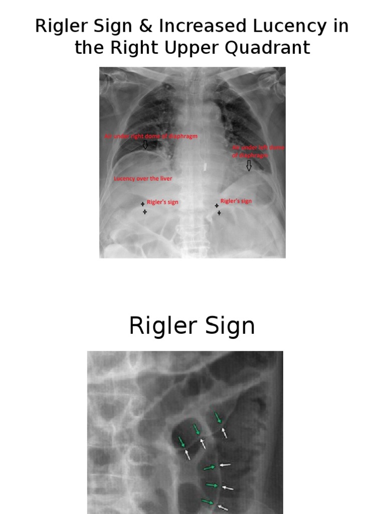 Rigler Sign & Increased Lucency in The Right Upper Quadrant | PDF