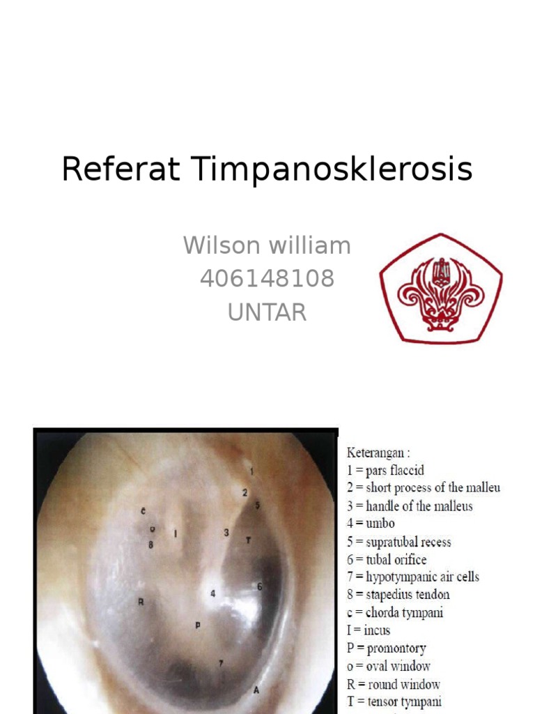 Timpanosklerosis | PDF