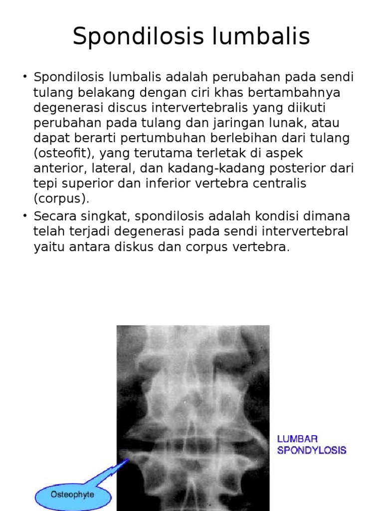 Spondilosis Lumbalis | PDF