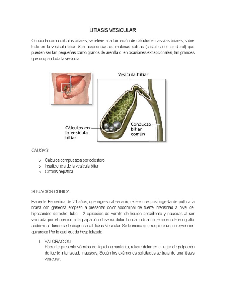 Litiasis Vesicular: Diagnóstico y Manejo Quirúrgico | PDF ...