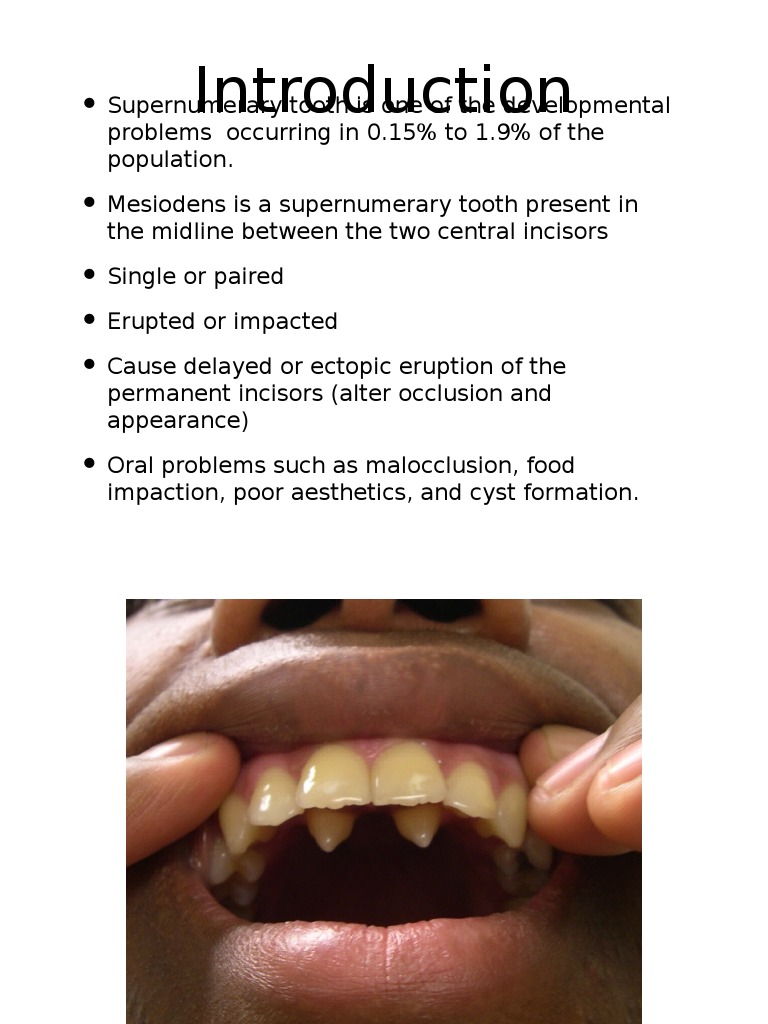 Supernumerary Tooth | PDF