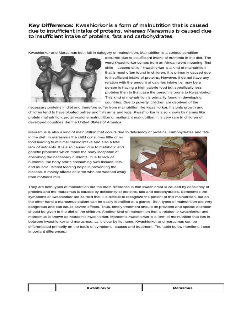 Kwashiorkor vs. Marasmus: Key Differences | PDF | Malnutrition | Nutrition