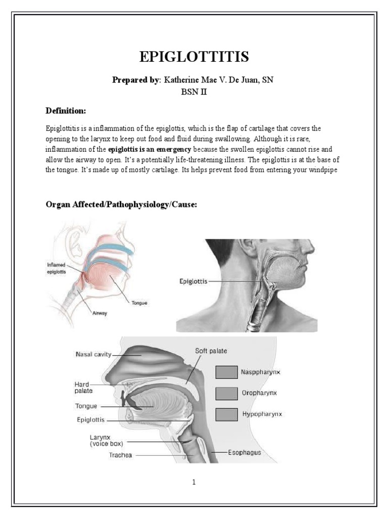 Epiglottitis Report | Respiratory Tract | Medical Specialties