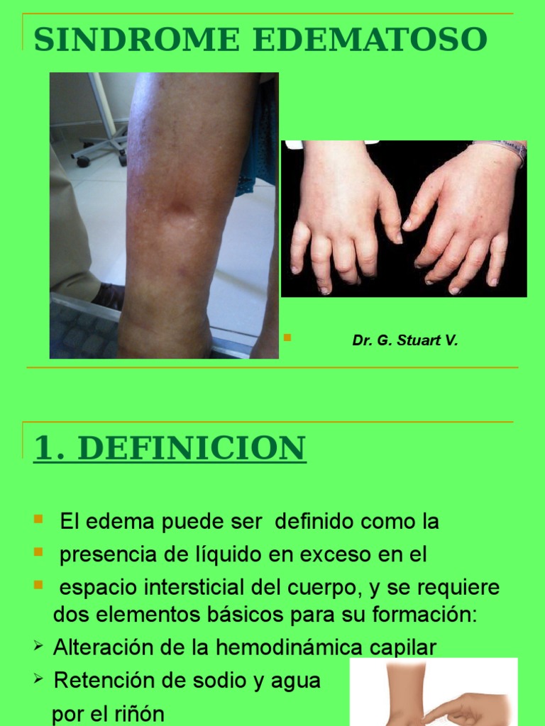 Síndrome Edematoso: Definición y Clasificación | PDF | Edema | Medicina