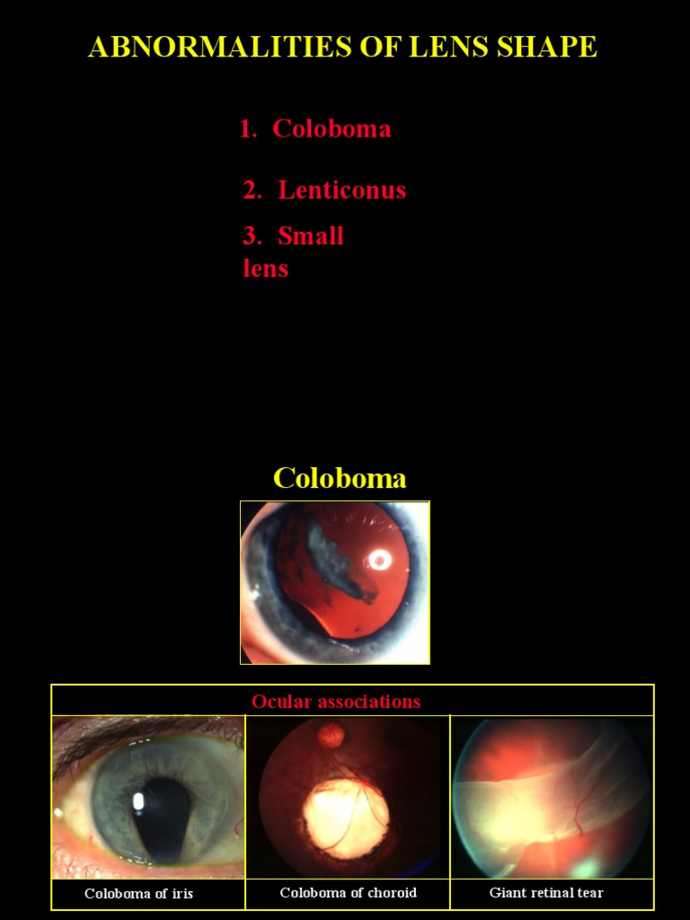 Abnormalities of Lens Shape: 1. Coloboma | PDF