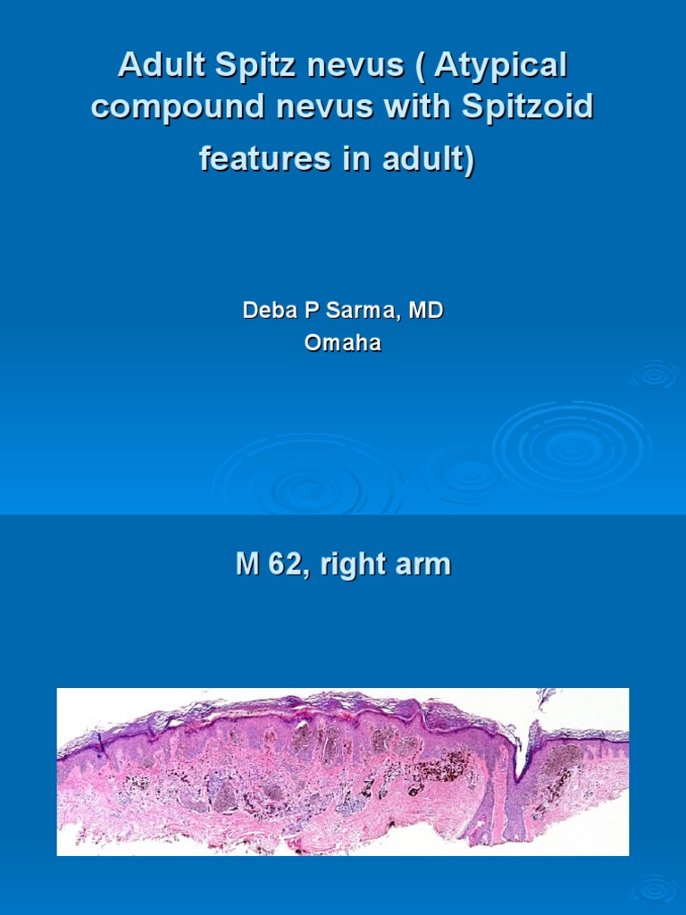 Adult Spitz Nevus (Atypical Compound Nevus With Spitzoid Features) . | PDF