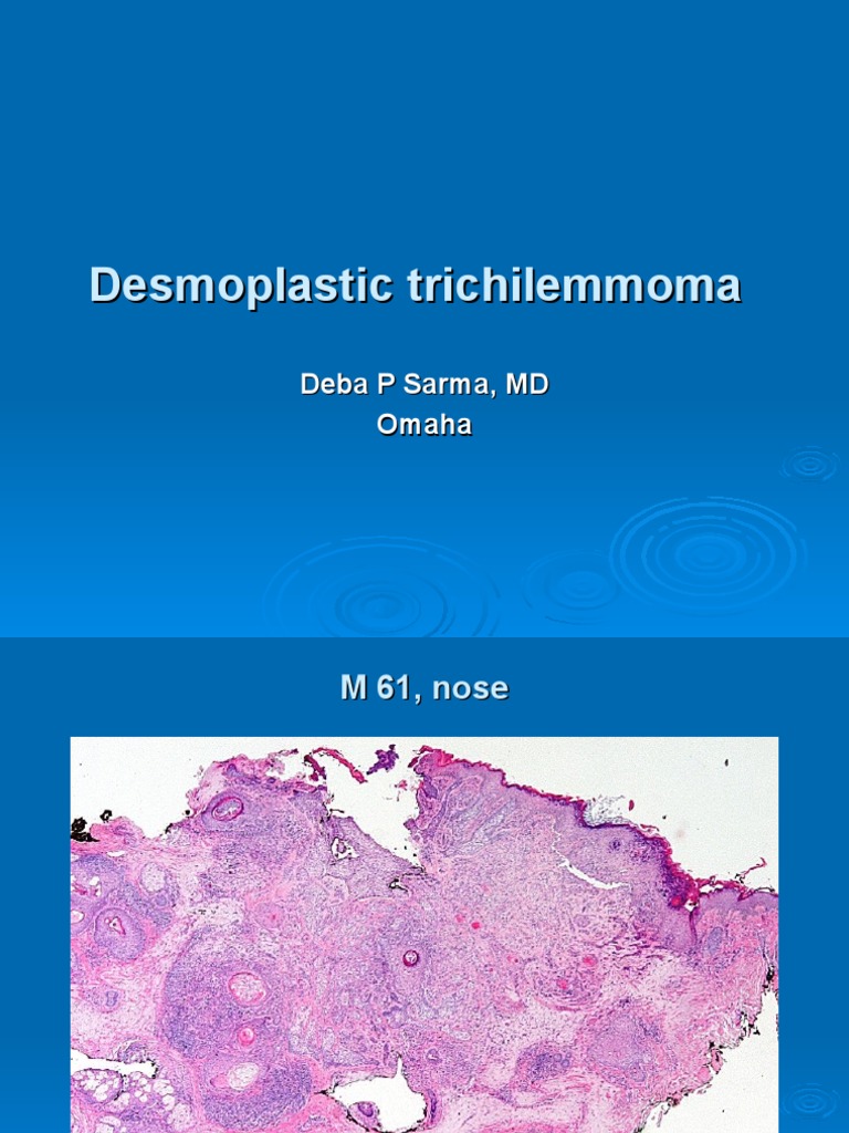 Desmoplastic Trichilemmoma Overview | PDF