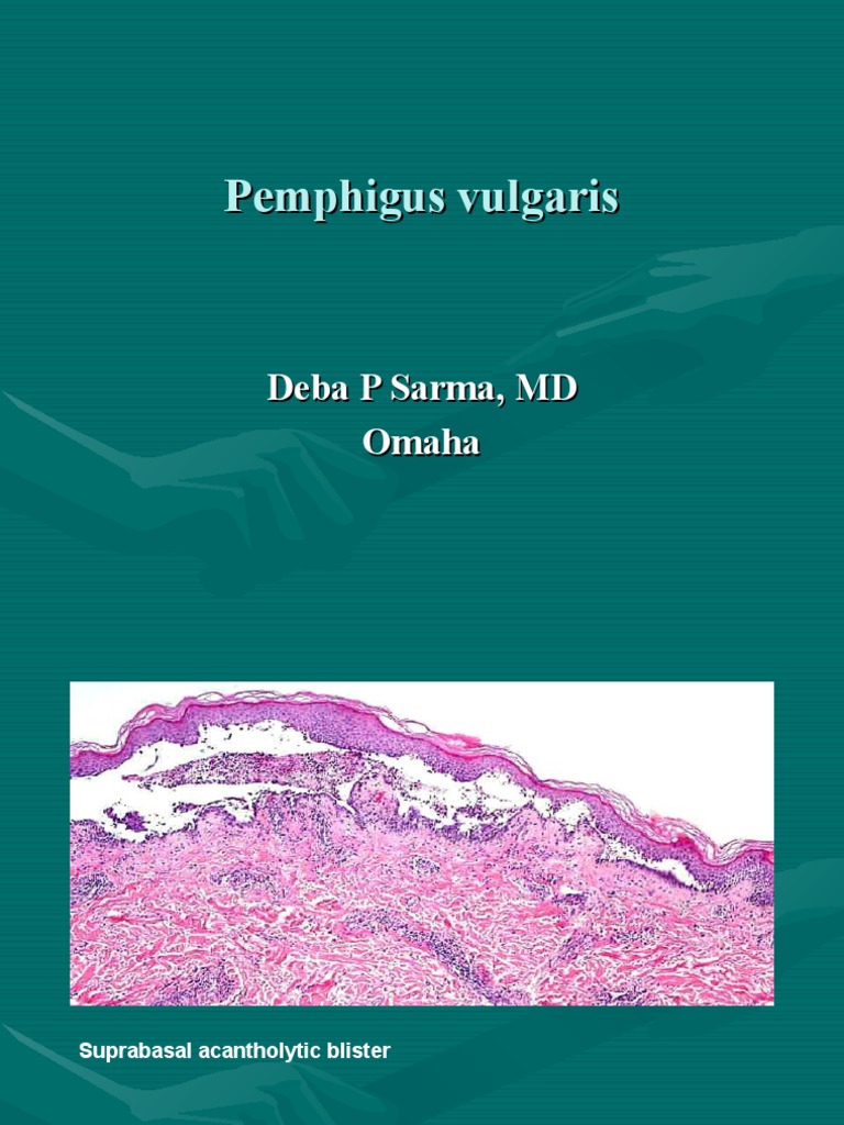 Pemphigus Vulgaris Pathology Overview | PDF | Autoimmune Disease ...