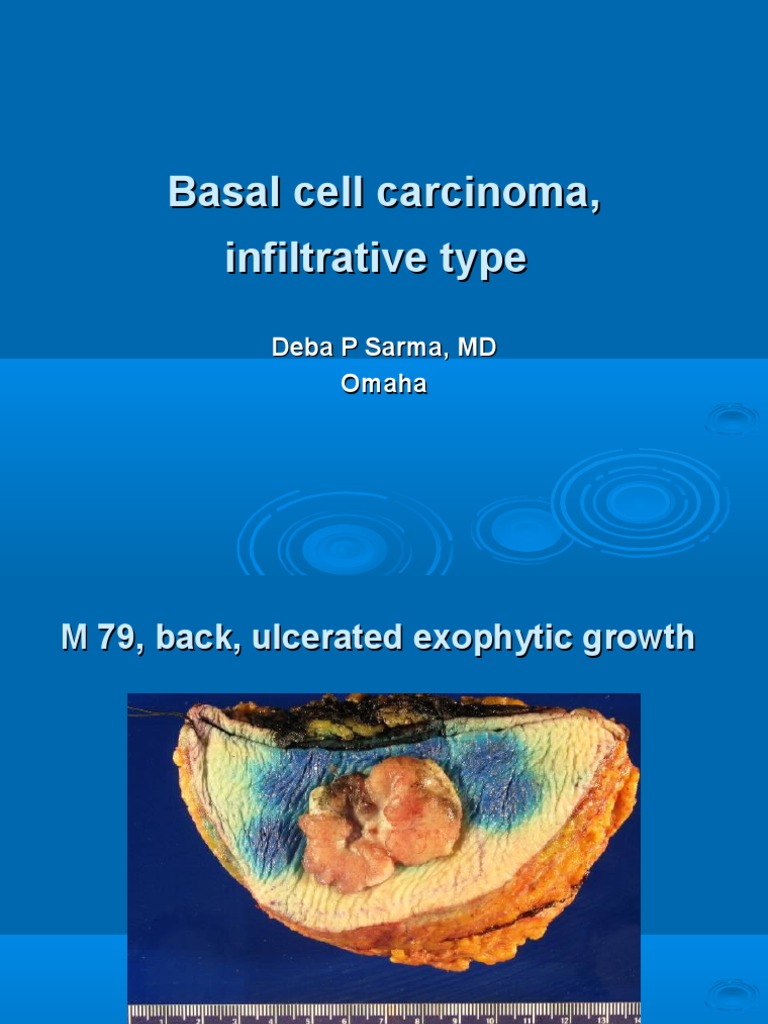 Basal Cell Carcinoma, Infiltrative Type | Carcinoma | Epidemiology