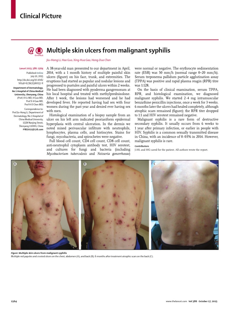 Multiple Skin Ulcers From Malignant Syphilis | Medical | Medicine