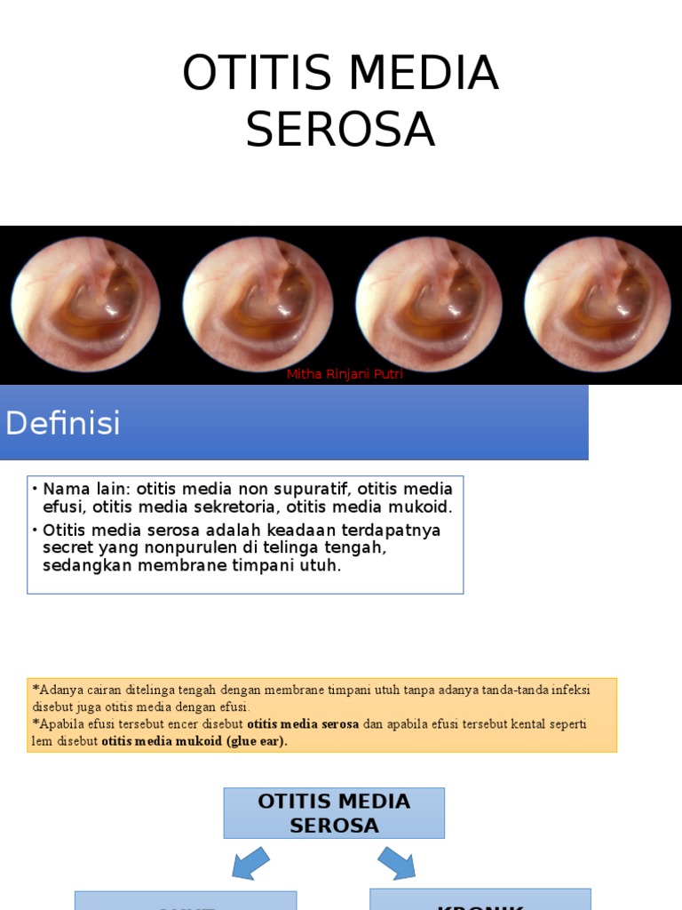 Otitis Media Serosa | PDF