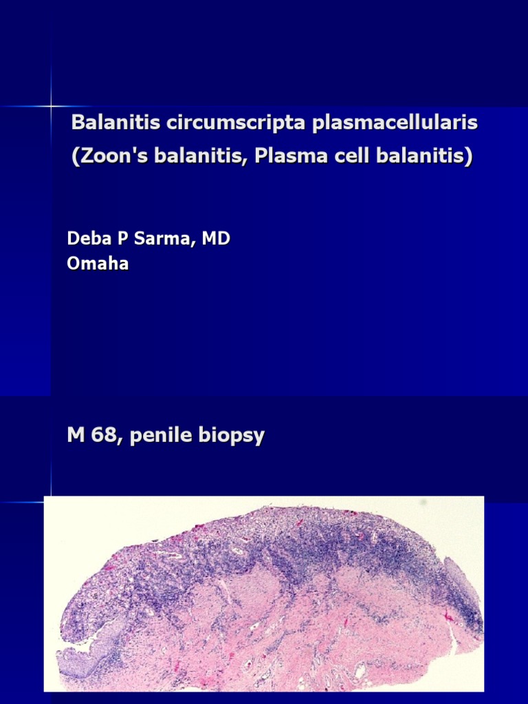 Balanitis Circumscripta Plasmacellularis (Zoon's Balanitis, Plasma Cell ...