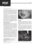 Hanifin and Rajka Diagnostic Criteria For Atopic Dermatitis | PDF ...