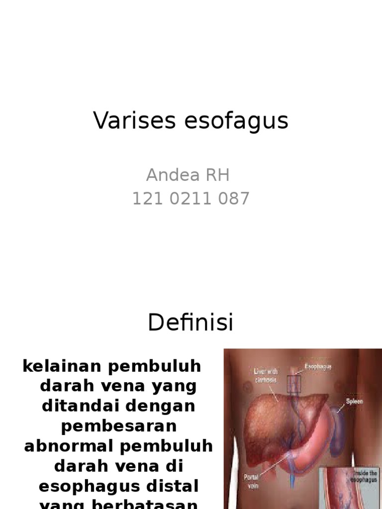 Varises Esofagus: Penyebab dan Penanganan | PDF