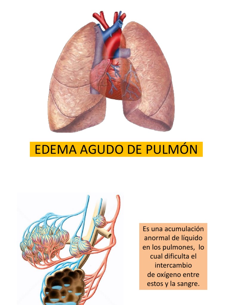 Edema Agudo De Pulmón Causas: Tratamiento Para Edema Pulmonar – VOBPV