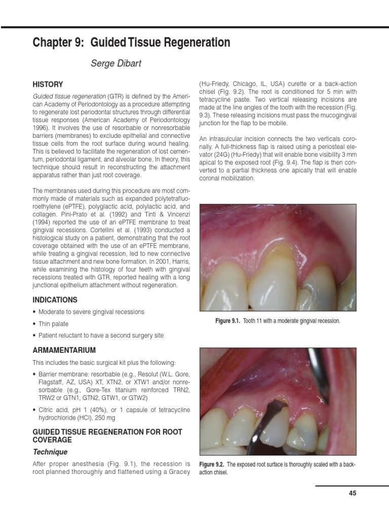 Guided Tissue Regeneration | PDF | Dentistry | Health Sciences