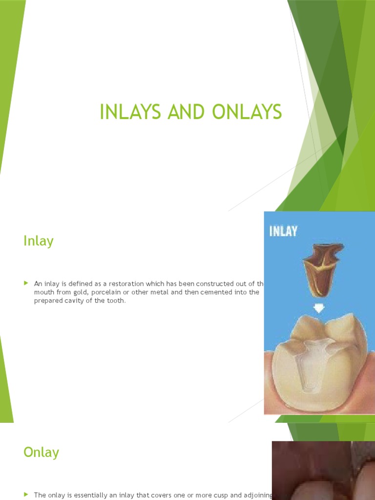 Inlays and Onlays Report | PDF | Mouth | Dentistry