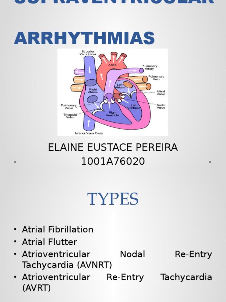 Supraventricular Arrhythmias Guide | PDF | Cardiac Arrhythmia ...