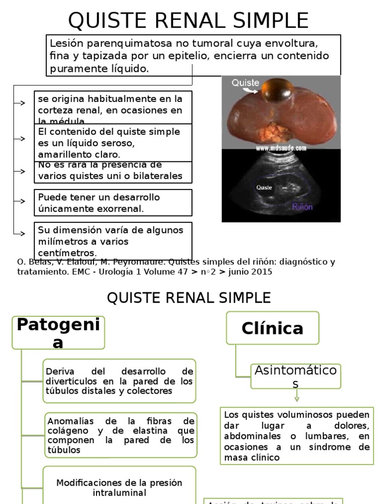 Quiste Renal Simple | Riñón | Anatomía
