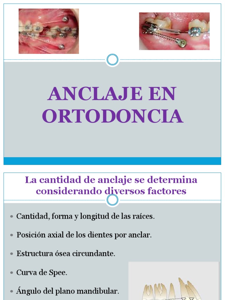 Tipos de Anclaje en Ortodoncia | PDF | Hogar, jardinería y bricolaje ...