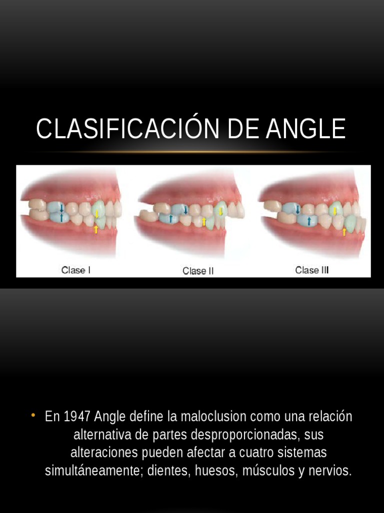 Clasificación de Angle | PDF | Odontología | Diente humano