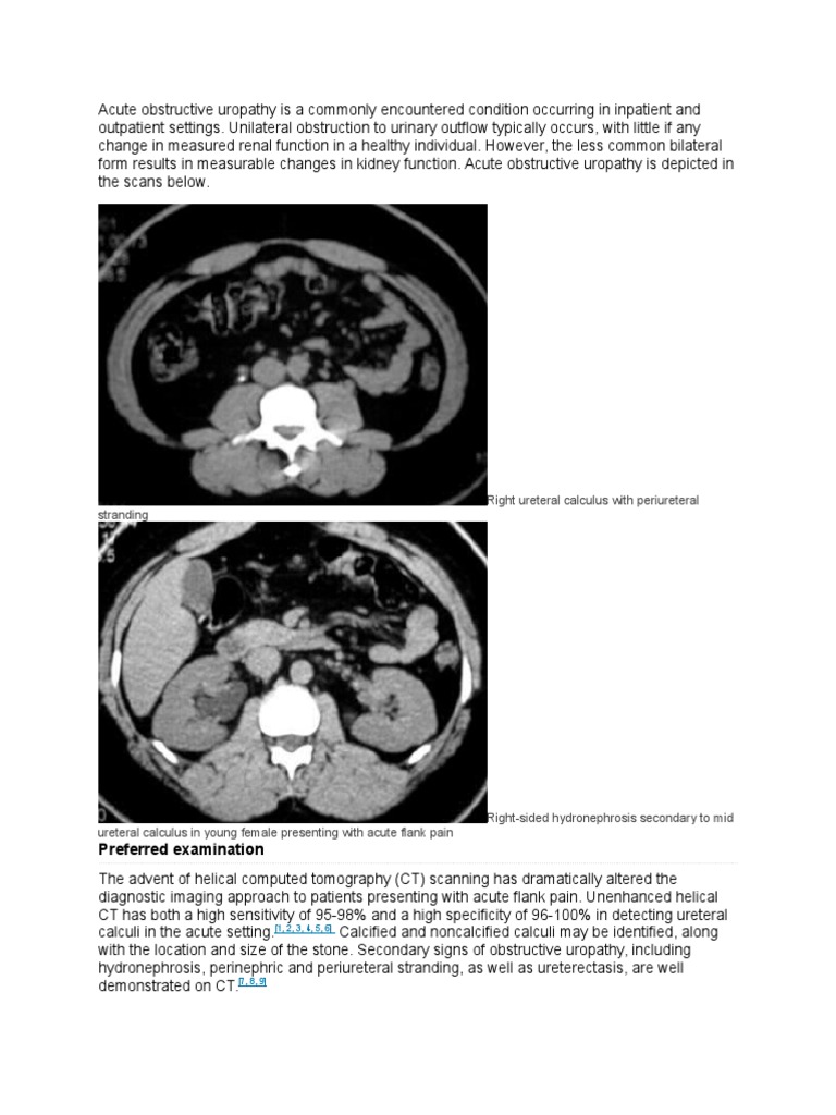 Acute Obstructive Uropathy Imaging Insights | PDF | Kidney | Ct Scan