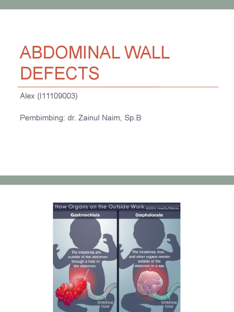 Abdominal Wall Defects | PDF